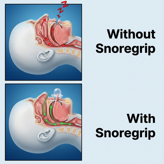 SnoreGrip Pro – Instant Snoring Relief – SnoreSolvers