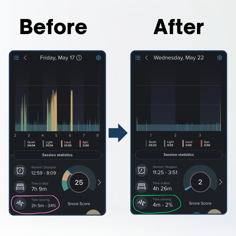 SnoreGrip Pro – Instant Snoring Relief – SnoreSolvers