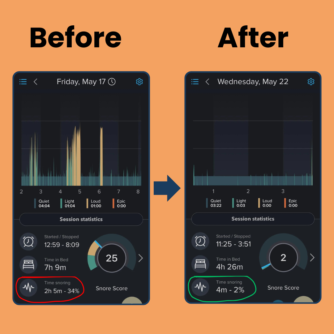 SnoreGrip Pro – Instant Snoring Relief – SnoreSolvers