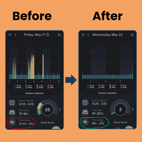 SnoreGrip Pro – Instant Snoring Relief – SnoreSolvers