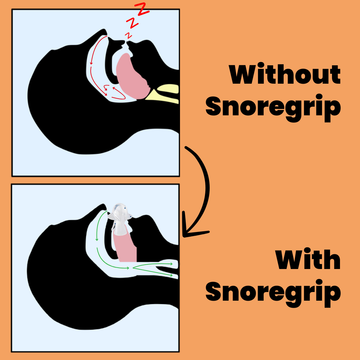SnoreGrip Pro – Instant Snoring Relief – SnoreSolvers